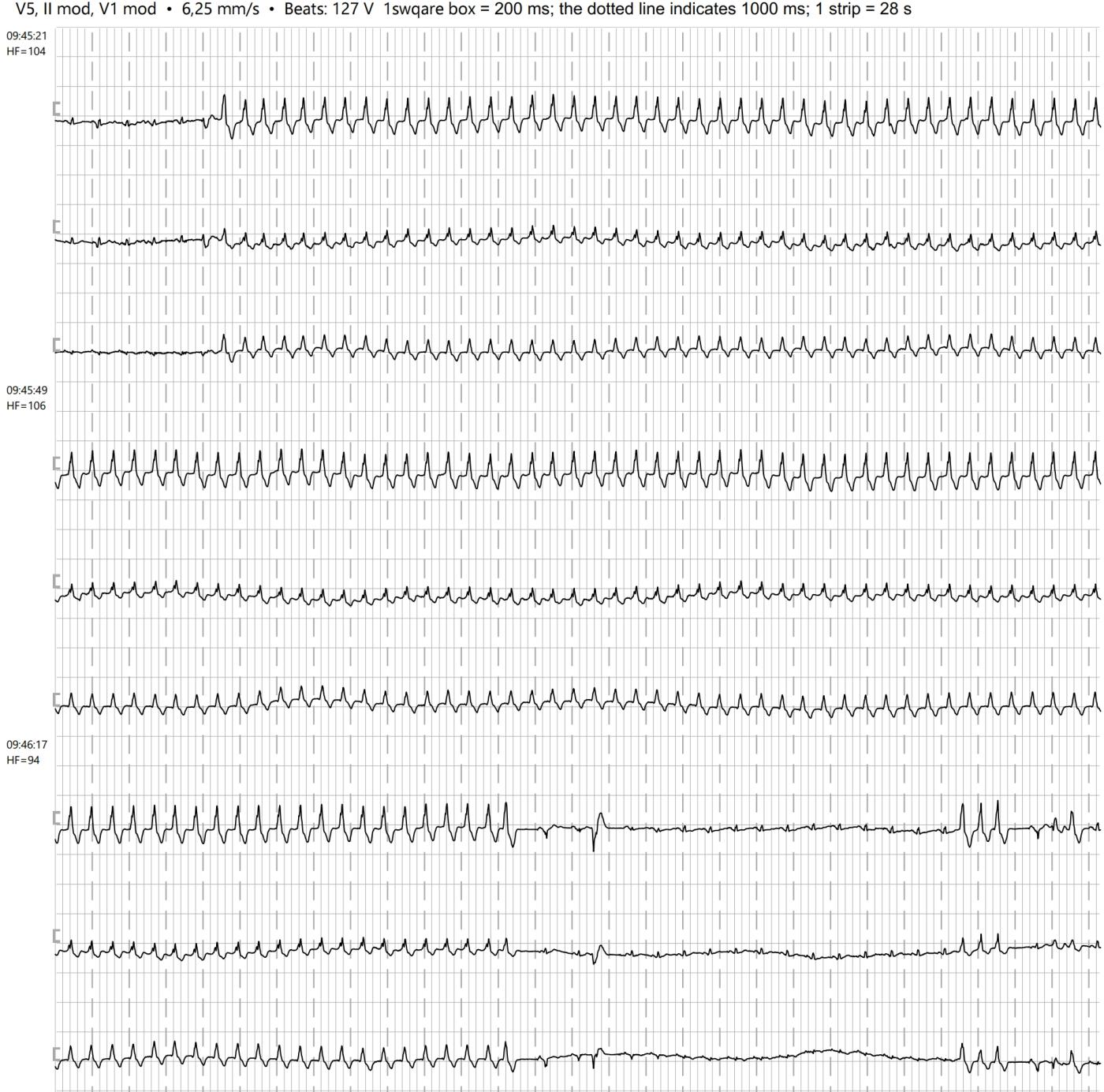 SUSTAINED VENTRICULAR TACHYCARDIA | ECG Guru - Instructor Resources